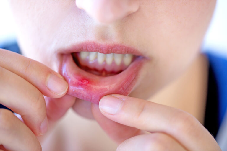 Canker Sores: What They Are and How to Treat Them | Health and Wellness