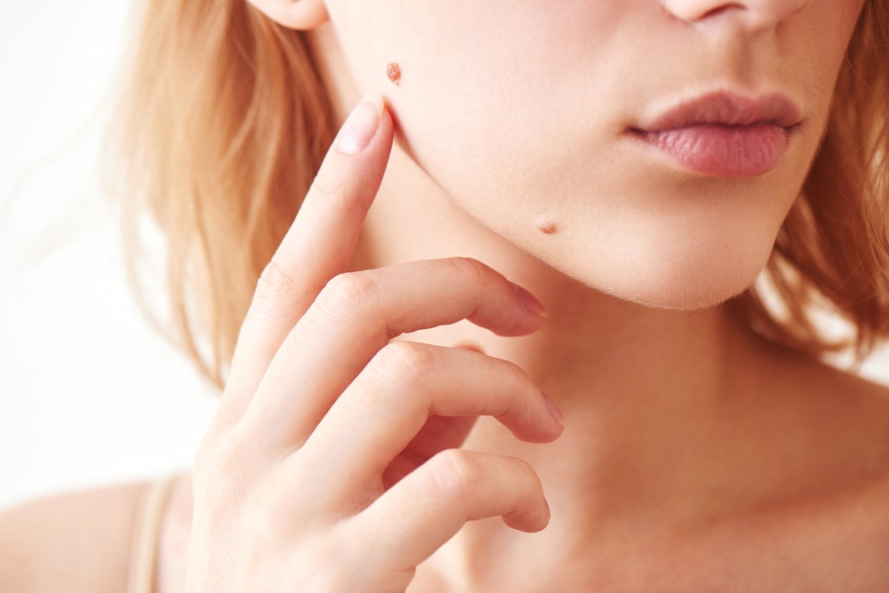 When Should You Worry About A New Mole? | Health and Wellness